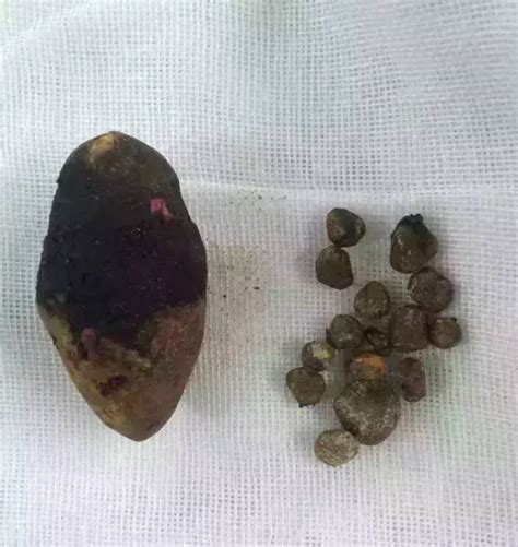 胆结石怎么消除胆结石怎么形成的胆结石有什么症状第5页大山谷图库