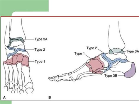 Charcot Joint Arthropathy Pptx Pptx