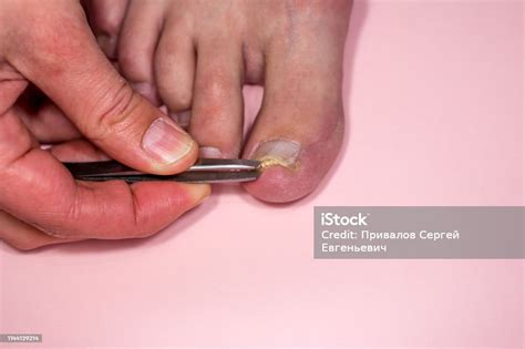 분홍색 배경에 고립 된 손 발톱 손톱 판에 기계적 손상 쉘 락 또는 젤 바니시 를 바른 후 손톱 손상 건강관리와 의술에 대한 스톡 사진 및 기타 이미지 Istock