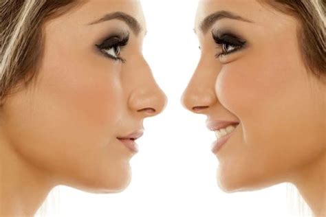 Rinoplastia O que é Como é feita Cuidados recuperação e mais