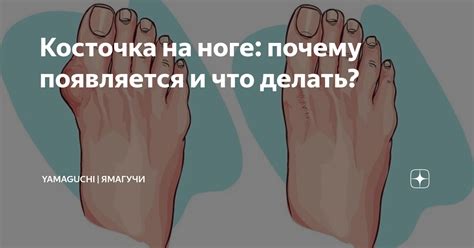 Косточка на ноге почему появляется и что делать Yamaguchi Ямагучи