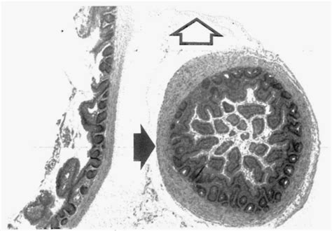 Photomicrograph Of Communicating Intestinal Ileum Duplication