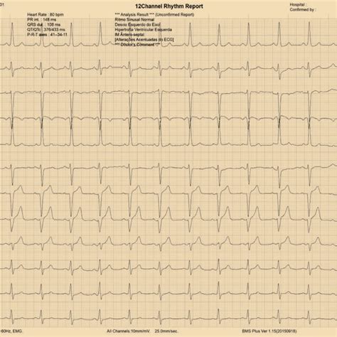 Ecg At The First Visit To The Clinic Showing Complete Lbbb With Market Download Scientific