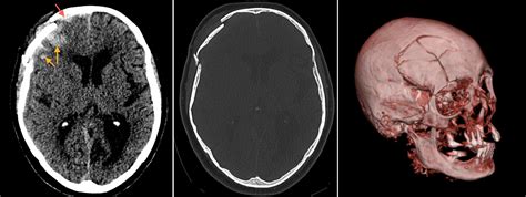 Basal Skull Fracture Temporal Bone At Angelina Chomley Blog