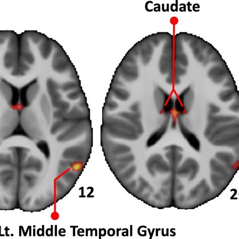 Regions Show Gray Matter Gm Volume Differences Between Patients With