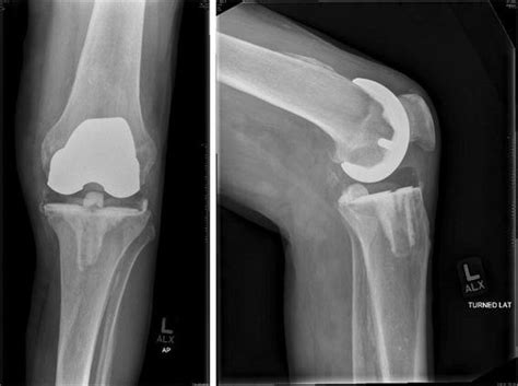 Ap And Lateral Radiograph Of Temporary Knee Replacement With All Poly