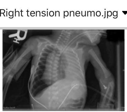 TMC II Flashcards Quizlet
