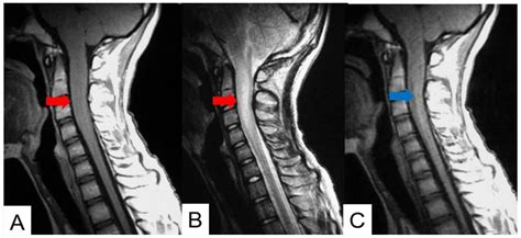 State Of The Art And New Treatment Approaches For Spinal Cord Tumors
