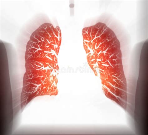 Ct Chest Scan Overview Shows Clear Lung Fields Heart And Mediastinum