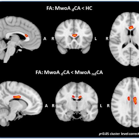 Tract Based Spatial Statistical Tbss Analysis Showing Differences In