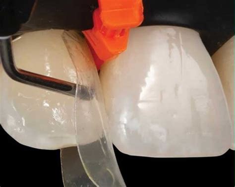 Clinical Case 21st Century Class Iii Restoration Using A Bioclear® Matrix Solventum