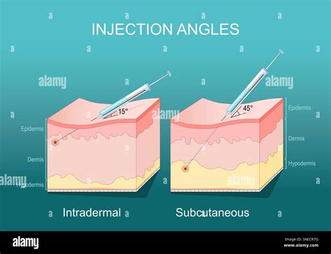 Injection Technique Needle Angle Cross Section Of Human Skin Layers