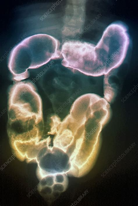 Intussusception Of The Intestine X Ray Stock Image C018 5605 Science Photo Library
