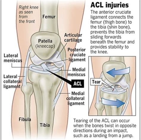 Acl Injuries Anatomy Medical Knowledge Medical Anatomy
