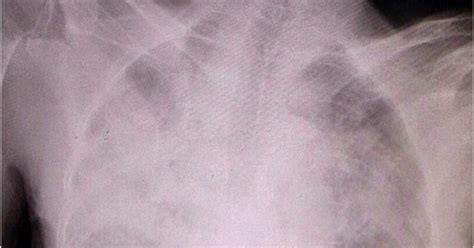 Phimaimedicine Diffuse Alveolar Hemorrhage