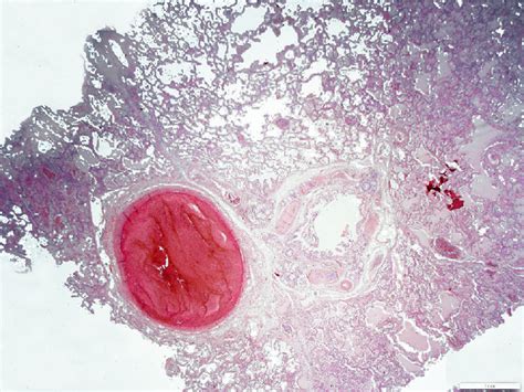 Photomicrography Of An Intralobar Pulmonary Artery With The End Of The
