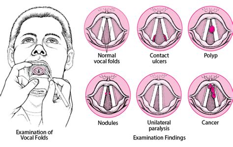 Vocal Fold Polyps Nodules And Granulomas Ear Nose And Throat