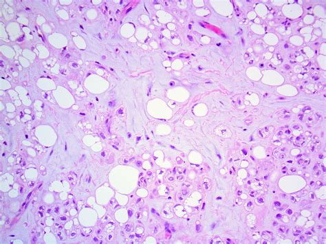 Chondroid Lipoma Of The Parotid Gland Diagnostic Histopathology