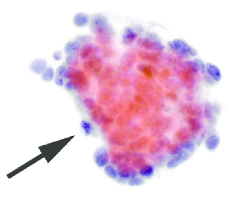 Cytological Findings The Examination Of The Pleural Fluid Demonstrated