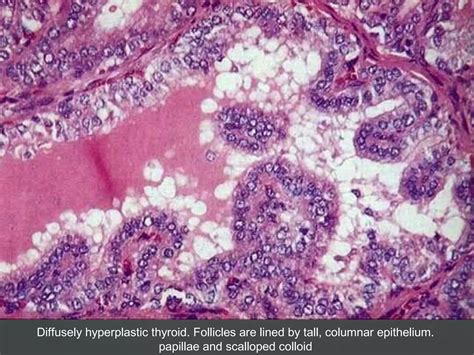 Hypo And Hyper Thyroidism Ppt