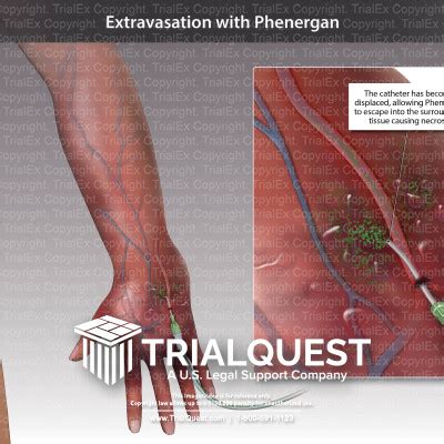 Medical Legal Exhibits Legal Animations Trial Graphics
