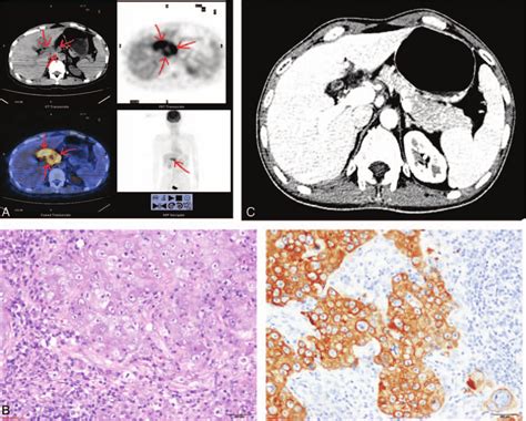 A Metastatic Hepatic Hilum And The Retroperitoneal Lymph Nodes From Download Scientific