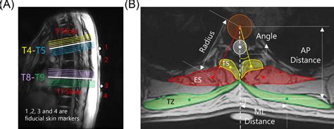 A Sagittal Mr Image Showing The Orientation Of The Parallel Slice