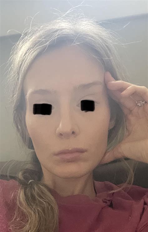 1 Year Post Op Open Rhinoplasty 😕 Rplasticsurgery