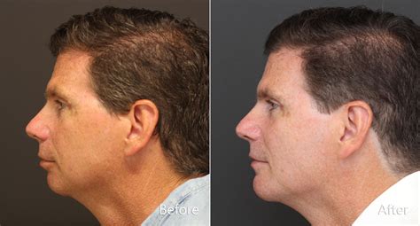 Chin Implants Photos Princeton Nj Patient 8640