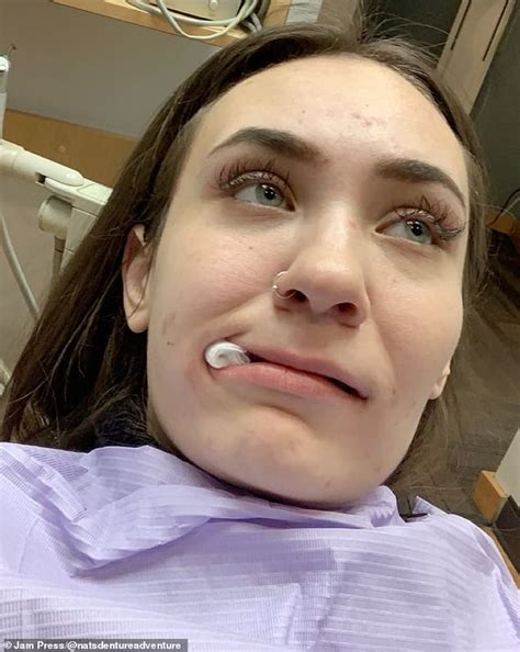 Woman 24 Whose Teeth Began To Rot From A Vomiting Condition At Age 19