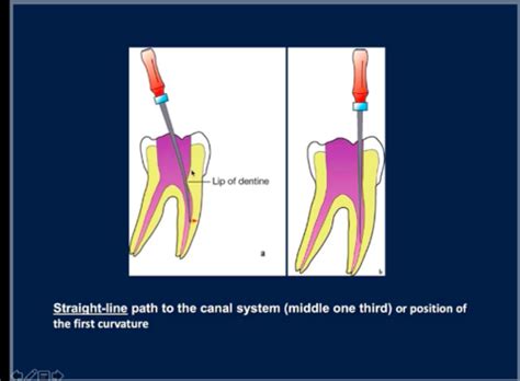 Endodontic Access Flashcards Quizlet