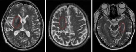 “확장된 뇌혈관 주위 공간이 알츠하이머 악화시켜” 헬스케어n 헬스조선헬스케어엔