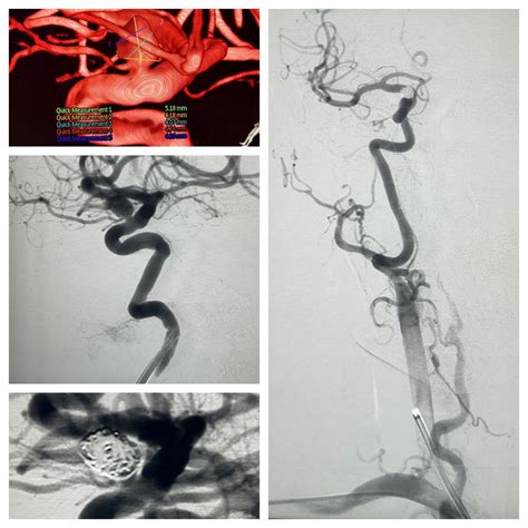 62 Year Old With Ruptured Ica Aneurysm Treated With Primary Coiling 6f Radial Fubuki 071