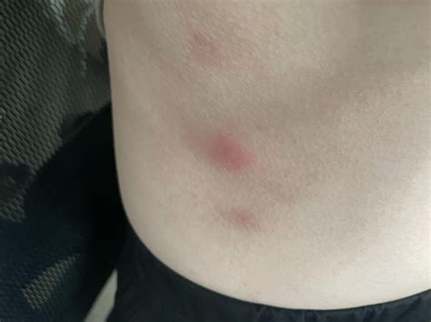 Bited By Unknown Bugs Rbedbugs