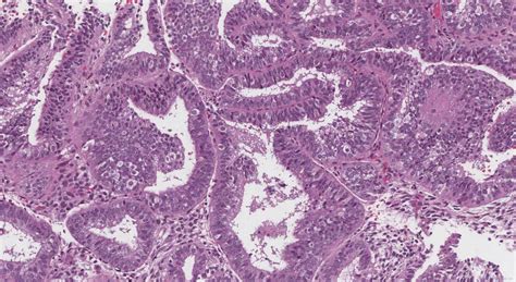 Uterine Angioleiomyoma With Atypia Raised Ca125 Levels And Pseudo