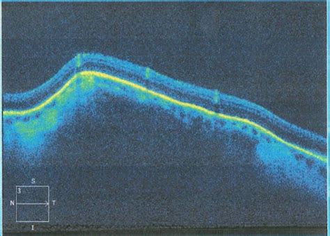 Sclerochoroidal Calcification Leads To Diagnosis Of Primary Parathyroid