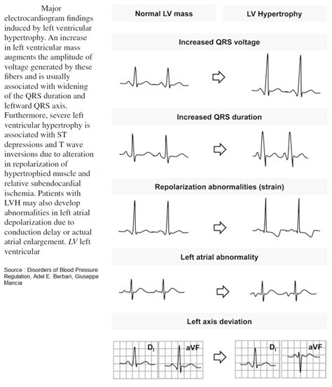 Atrial Enlargement On Ekg