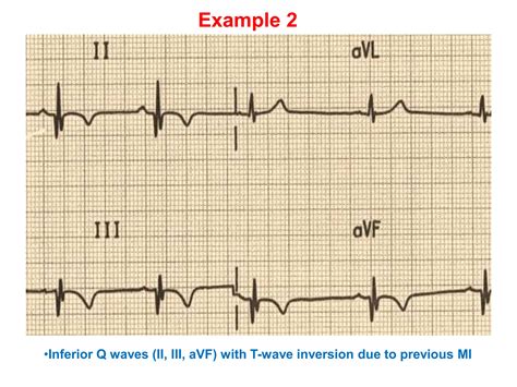 Q Wave In Ecgcauses Of Pathological Q Waves Pptx