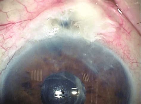 At Presentation Note The Extremely Thin And Avascular Bleb And The Download Scientific Diagram