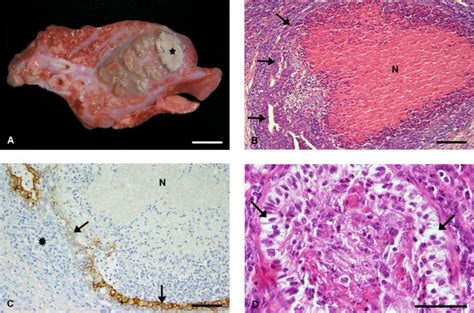 A Gross Pathology Of Caseonecrotic Pneumonia Cut Surfaces Of Lung
