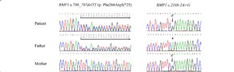 Mutation Analysis Direct Sequencing Shows That The Proband Is Compound