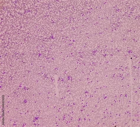 Leukemia Blood Cells Blast Cells And Immature Leukocytic Cells In