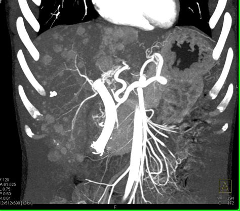 Metastatic Neuroendocrine Tumor Pancreas Case Studies Ctisus Ct