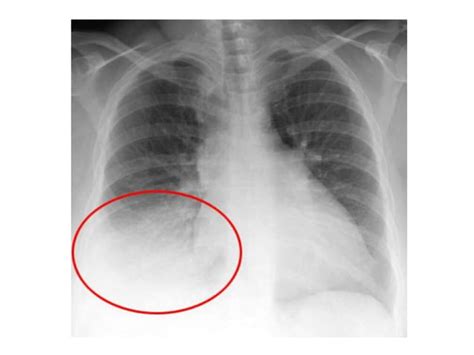 Acute Respiratory Infectionspptx