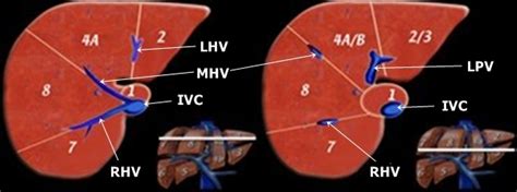 Liver Segmental Anatomy Ct Scan