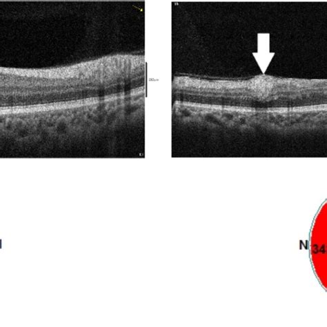 Optical Coherence Tomography Angiography Octa Of Optic Nerve Head And