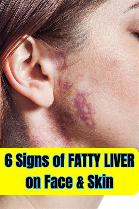Signs Of Liver Issues On Skin Jaundice Cure Liver Health Liver Issues