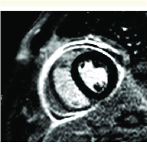 Cardiovascular Magnetic Resonance Imaging Late Gadolinium Imaging