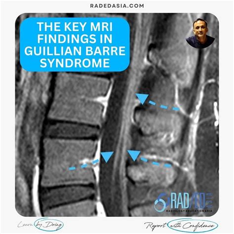 Mri Findings In Guillian Barre Syndrome Radiology Education Asia