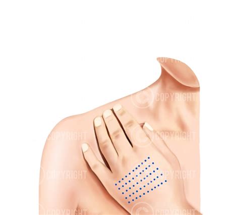 mesotherapy injection patterns botox and filler injector anatomy